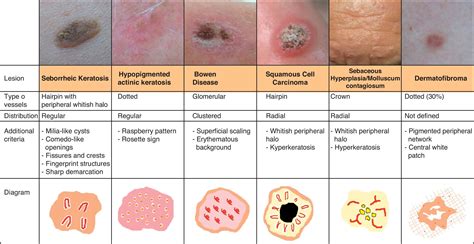 Vascular Patterns In Dermoscopy Actas Dermo Sifiliográficas