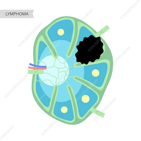 Lymphoma Conceptual Illustration Stock Image F0373567 Science