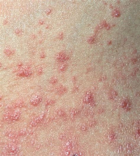 Guttate Psoriasis