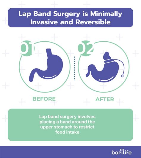 Lap Band Bariatric Surgery 7 Essential Facts You Need To Know