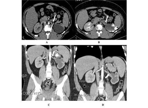 Ctu A Axial Arterial Phase B Excretory Phase Showing Left Renal