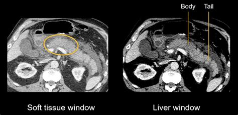 Abdominal Ct Necrotizing Pancreatitis • Litfl • Radiology Library