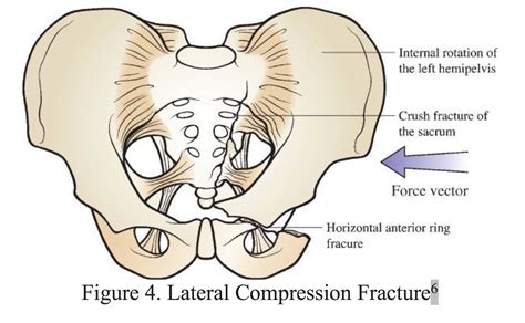 Compression Fracture Precautions At Eldon Berthold Blog