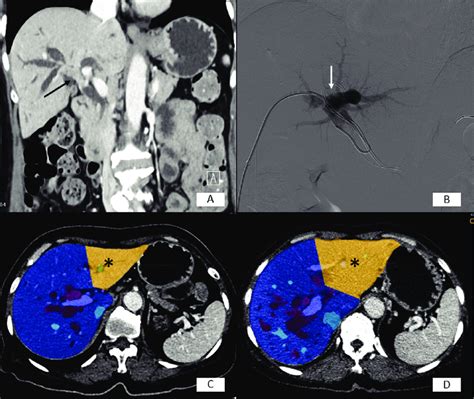A 65 Year Old Female Patient With Perihilar Type Cholangiocarcinoma