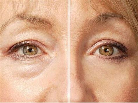 Ці 3 аптечні засоби усунуть мішки під очима та підтягніть шкіру не гірше дорогих кремів Читайте