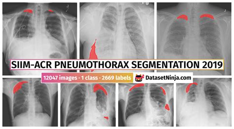 siim acr pneumothorax segmentation 2019 dataset ninja