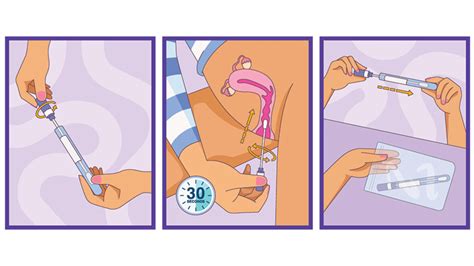 HPV Self Collection Testing Kits End Pap Smears NT News