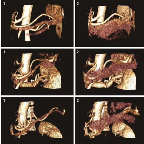 The Anatomical Configuration Of The Splenic Artery Influences Suprapancreatic Lymph Node