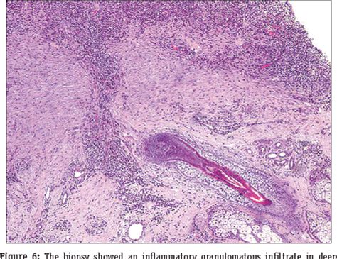 Figure 3 From Alopecic And Aseptic Nodules Of The Scalp With Trichoscopic And Ultrasonographic