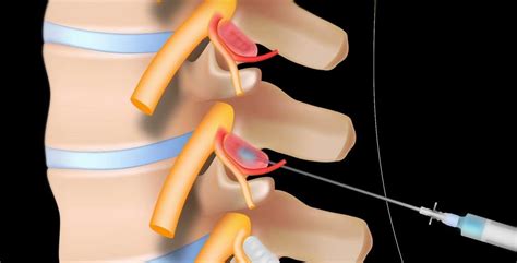 Facet Joint Injections Arthurcare