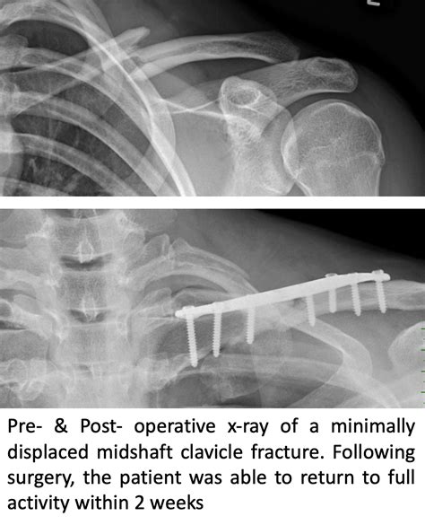 Cpt Code Clavicle Orif At Norman Nelson Blog
