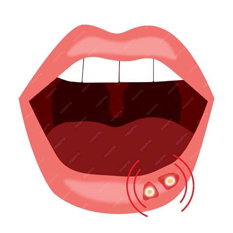 Estomatitis Aftosa De Vector Libre En La Boca Vector Premium