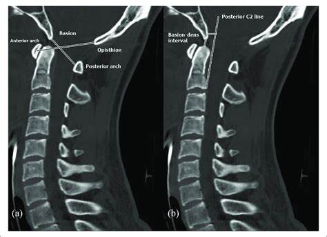What Is A Cervical Spine Ct Scan Two Views 60 Off