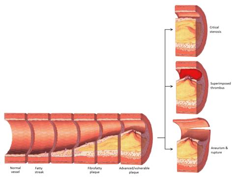 Peripheral Artery Disease Pad — Definition Stages And Treatment