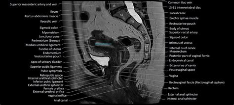 Female Pelvis Mri Anatomy Labelled Mri Atlas