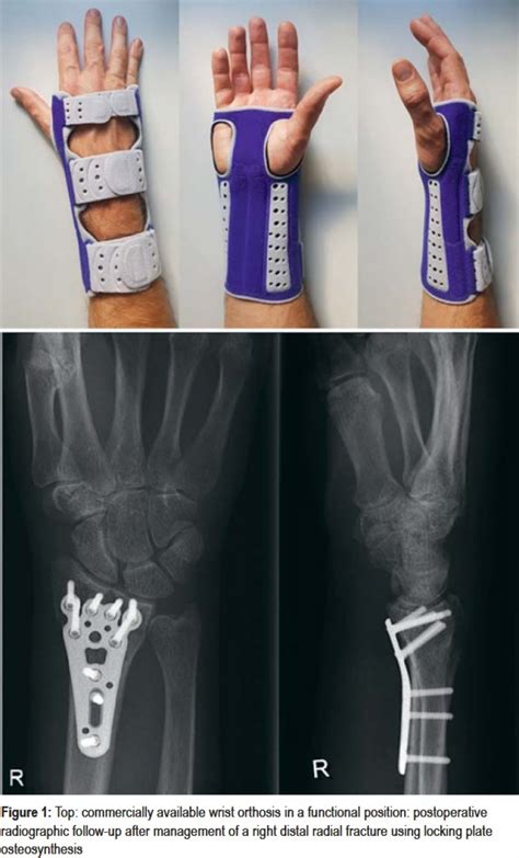 Early Mobilization Versus Splinting After Surgical Management Of Distal Radius Fractures 26 06