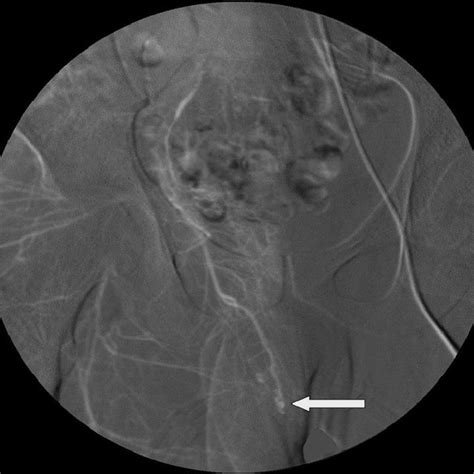 Right Cavernosal Artery Pseudoaneurysm A Gd Mra Of The Penis Showing