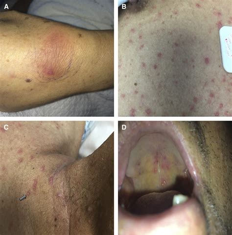 Skin Lesion Of Histoplasmosis Causes Symptoms Treatment Skin Lesion