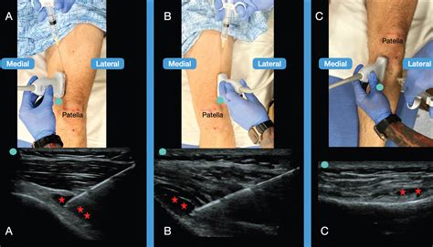 The Ultrasound Guided Genicular Nerve Block Page 2 Of 3 Acep Now Page 2