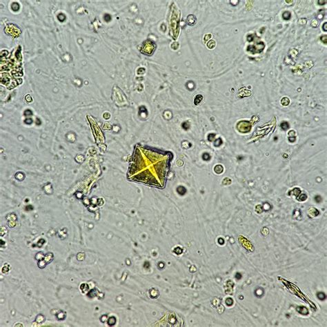 Calcium Oxalate Crystals Identification And Clinical Significance