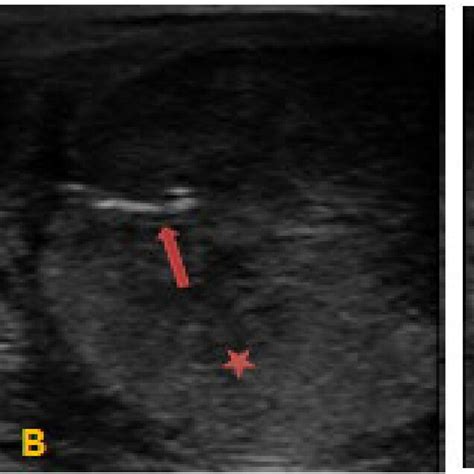 A Normal Homogeneous Mildly Echogenic Testicular Parenchyma Before