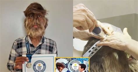 1㎠ 당 202개 털 자라 세상서 얼굴 털 가장 많은 18세男 기네스북 올라