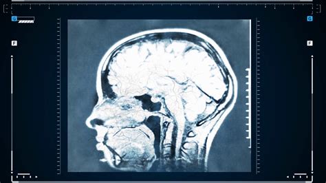 Brain Scan Visualization Animation Special Medical Equipment For Tumor