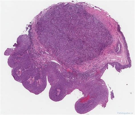 Larynx Archives Atlas Of Pathology