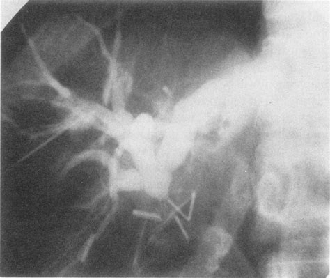 Percutaneous Transhepatic Cholangiogram Showing A Bismuth Type Ii Download Scientific Diagram