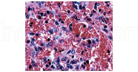 Figure 1 From Chapter 5 Acute Splenic Sequestration Crisis Semantic Scholar