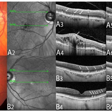 Correlations Phicramer V Between Mnv Type And Druse Type With