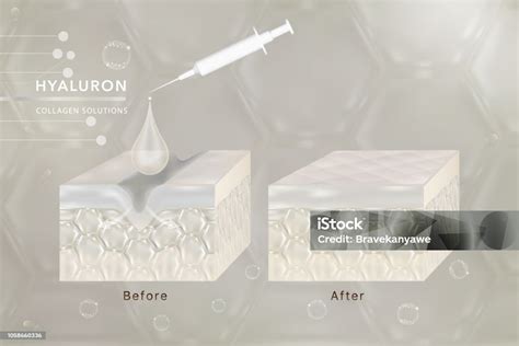 히 알루 론 산 피부 솔루션 광고 화이트 콜라겐 세럼 드롭 화장품 광고 배경 3d 그림에서 주사기를 사용 준비 개념에 대한 스톡 벡터 아트 및 기타 이미지 Istock