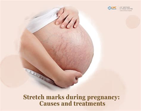 Stretch Marks During Pregnancy Causes And Treatments