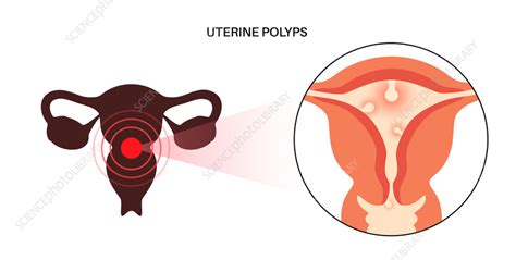Uterine Polyps Illustration Stock Image F0365590 Science Photo