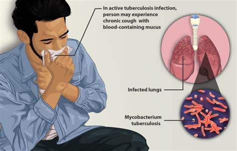 Tuberculosis Tb Causes Sign And Symptoms Treatment Dr Thind