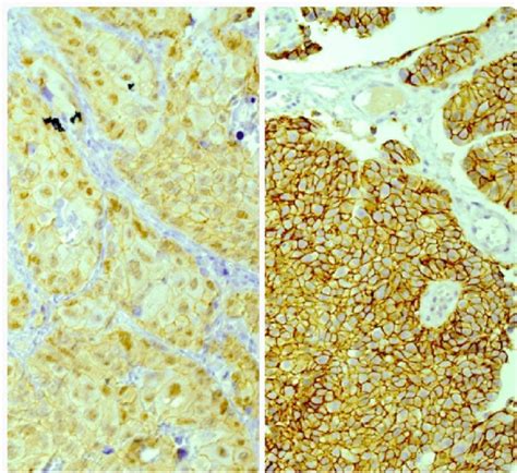 Histopathological Evaluation Of Bladder Neoplasms Showed High Grade