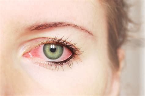Eye Mucus Symptoms Eye Discharge Causes Kaaqk