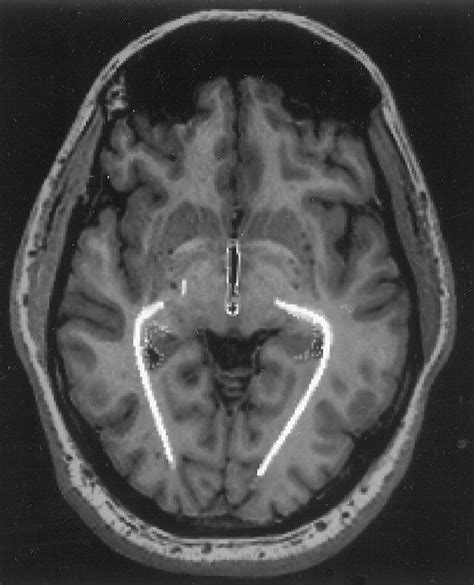Registration Of The Optic Radiations Of The Primary Visual Tracts From