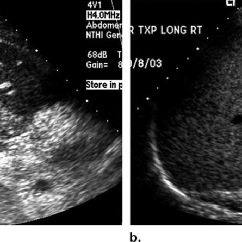 Monophasic Flow In A 39 Year Old Patient A Duplex Doppler Us Image Download Scientific