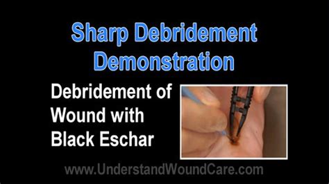 Sharp Debridement Vohra Wound Physicians