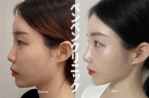 【ペンペン】糸リフトが重要な理由症例写真資料 「韓国糸リフトno1」ペンペンクリニック
