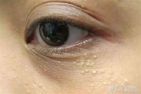 人人都长的脂肪粒，到底是个啥？ 知乎