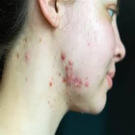 Acne Detection Yolov8 Object Detection Dataset By Fyp Acne Detection