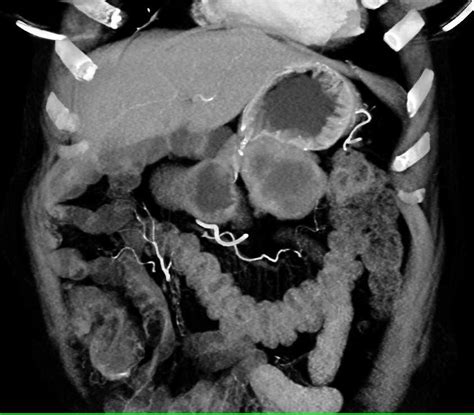 Gastric Gist Tumor Simulates A Pancreatic Mass Stomach Radiology Case