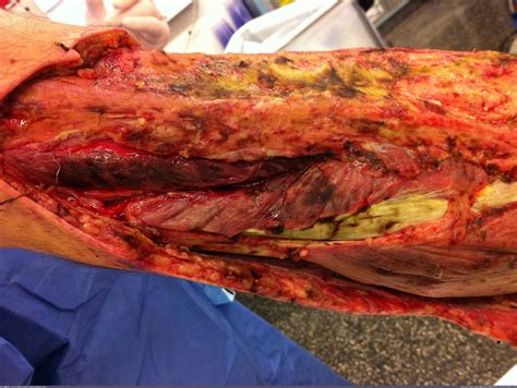 Pic Wtf Friend Fasciitis Necrotizing Had Stepdad 844577b My R Wtf Favs