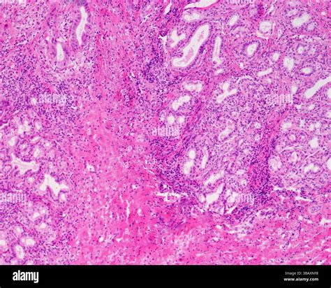 Light Micrograph Of Cholangiocarcinoma Ductal Type In A Human Liver