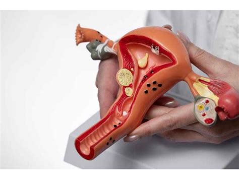 4 vị trí trong cơ thể dễ mọc polyp lâu dần có thể phát triển thành ung thư