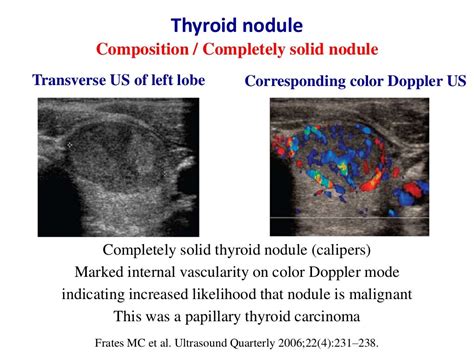 Thyroid Nodules