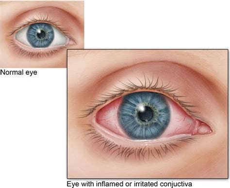 Parinaud Oculoglandular Syndrome