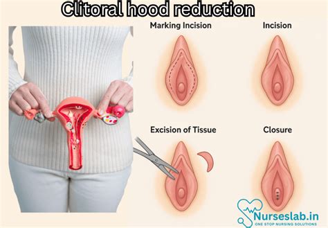Clitoral Hood Reduction A Comprehensive Review Nurseslab